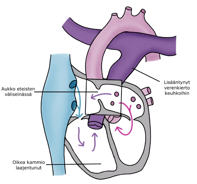 Eteisten väliseinän aukko, ASD - Sydänlapset ja -aikuiset ry