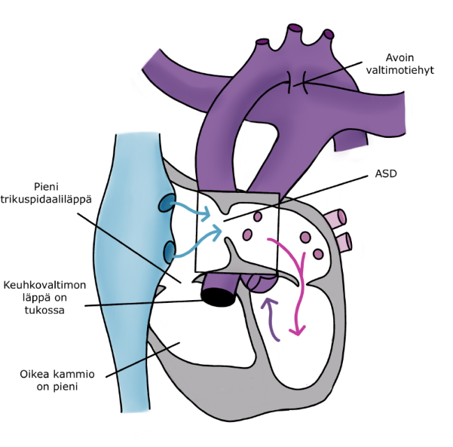 Pulmonaaliatresia ilman kammioväliseinäaukkoa, PA+IVS - Sydänlapset ja ...