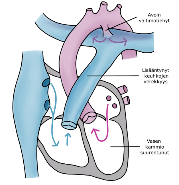 Avoin valtimotiehyt, PDA - Sydänlapset ja -aikuiset ry